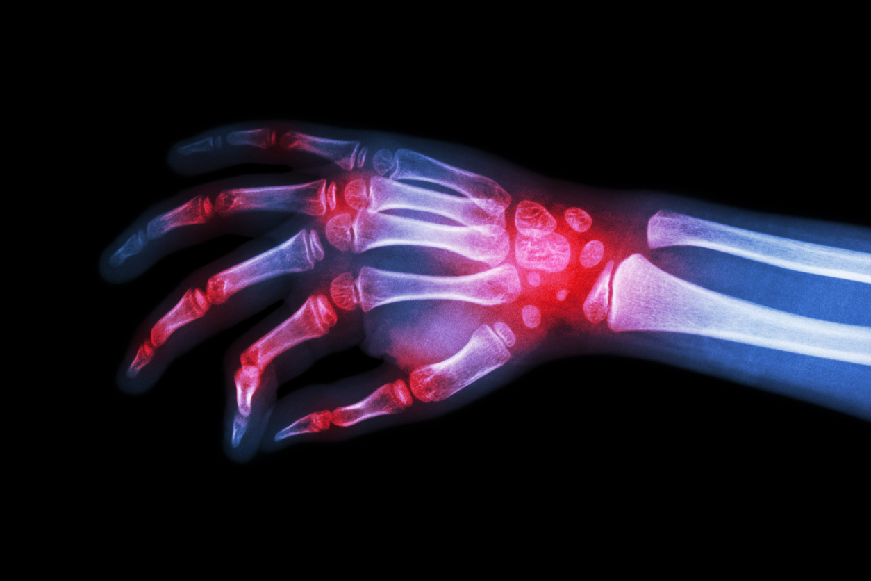 High Uric Acid : Causes, Symptoms and Treatment